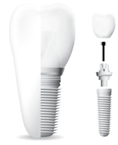 Stunning Dental Implants With Dr. McCraw | Mauldin, SC